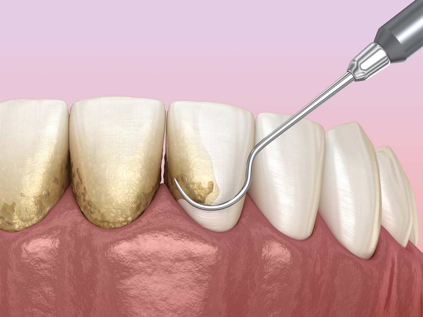 Le détartrage – Cabinet dentaire Charron